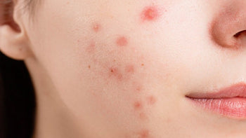 Tips for Acne-Prone Skin: How to Minimize Breakouts