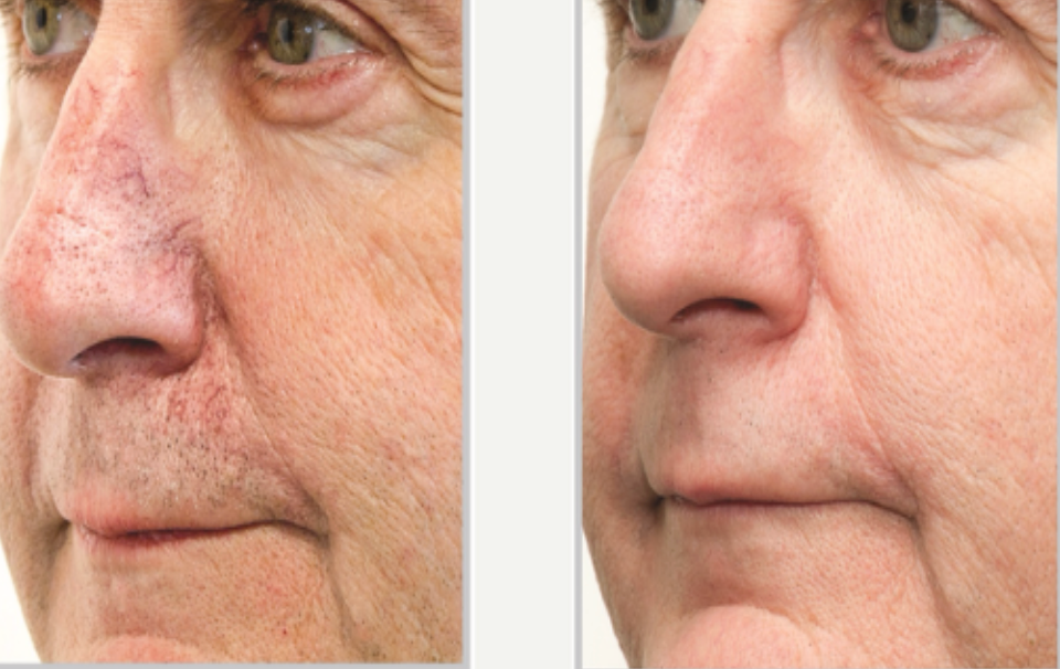LED Face Mask Light Therapy | Before & After Skin Results
